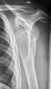 Shoulder Dislocation (Glenohumeral Joint Dislocation)