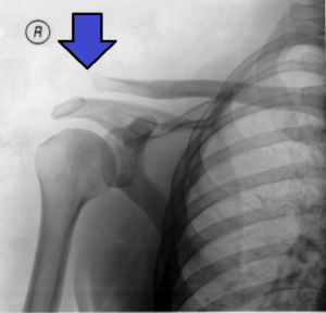 Acromioclavicular (AC) Joint Separation (Shoulder Separation ...